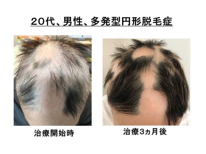 傷んだ毛の生え変わりを経て、治療3ヵ月で改善！生え変わりとは？ 患者様からの声・メディア掲載・クリニックからのお知らせ 名古屋kクリニック